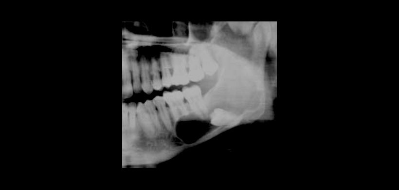 099 Características Radiológicas Del Quiste Odontogénico Glandular