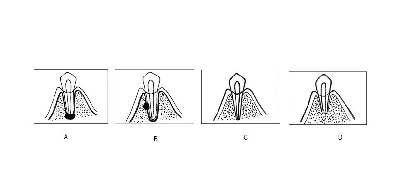 159 Reabsorción Dentaria Etiopatogenia Y Clasificación Idm