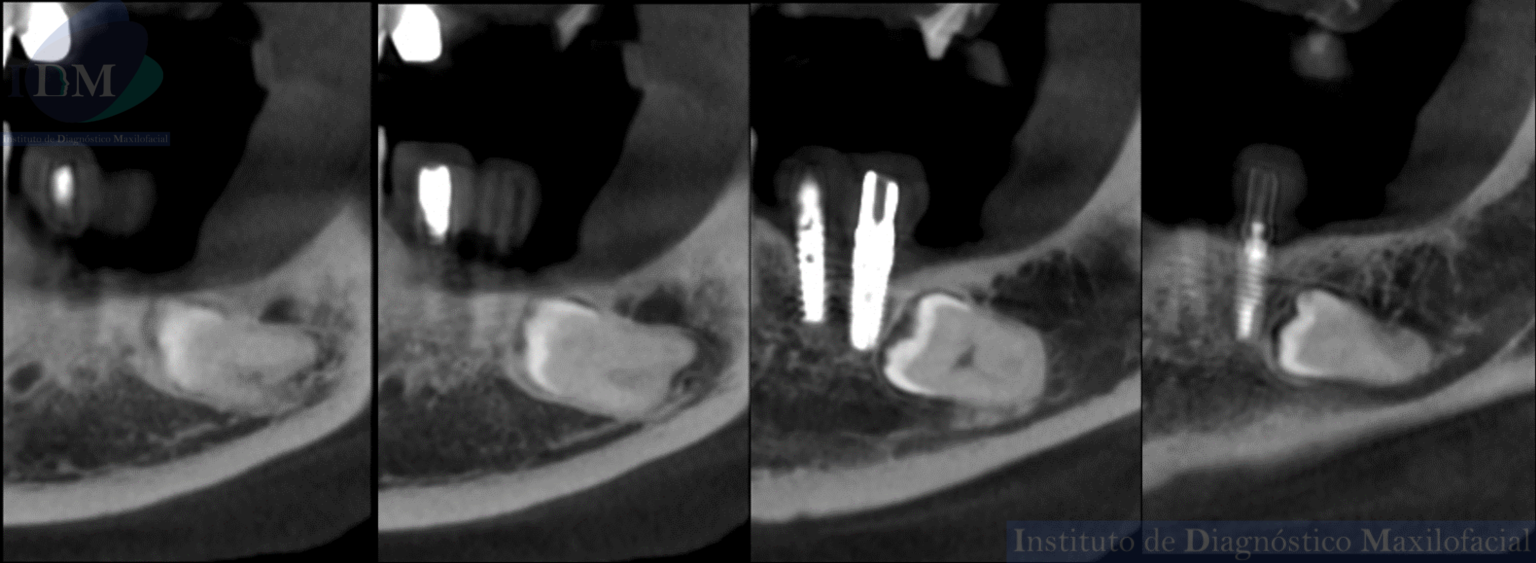 Caso 262 - IDM - ANQUILOSIS DENTOALVEOLAR - IDM