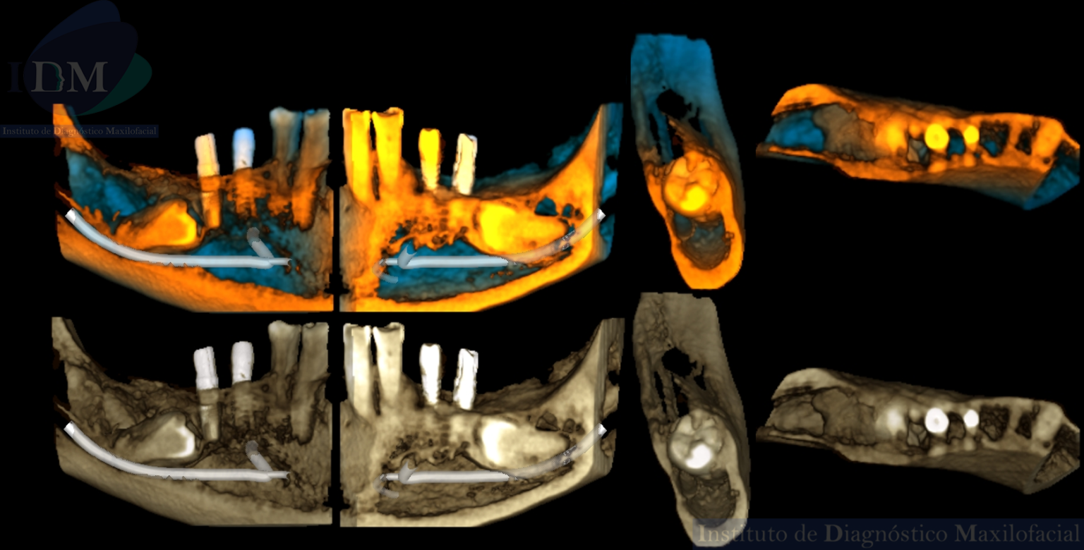 Caso 262 - IDM - ANQUILOSIS DENTOALVEOLAR - IDM