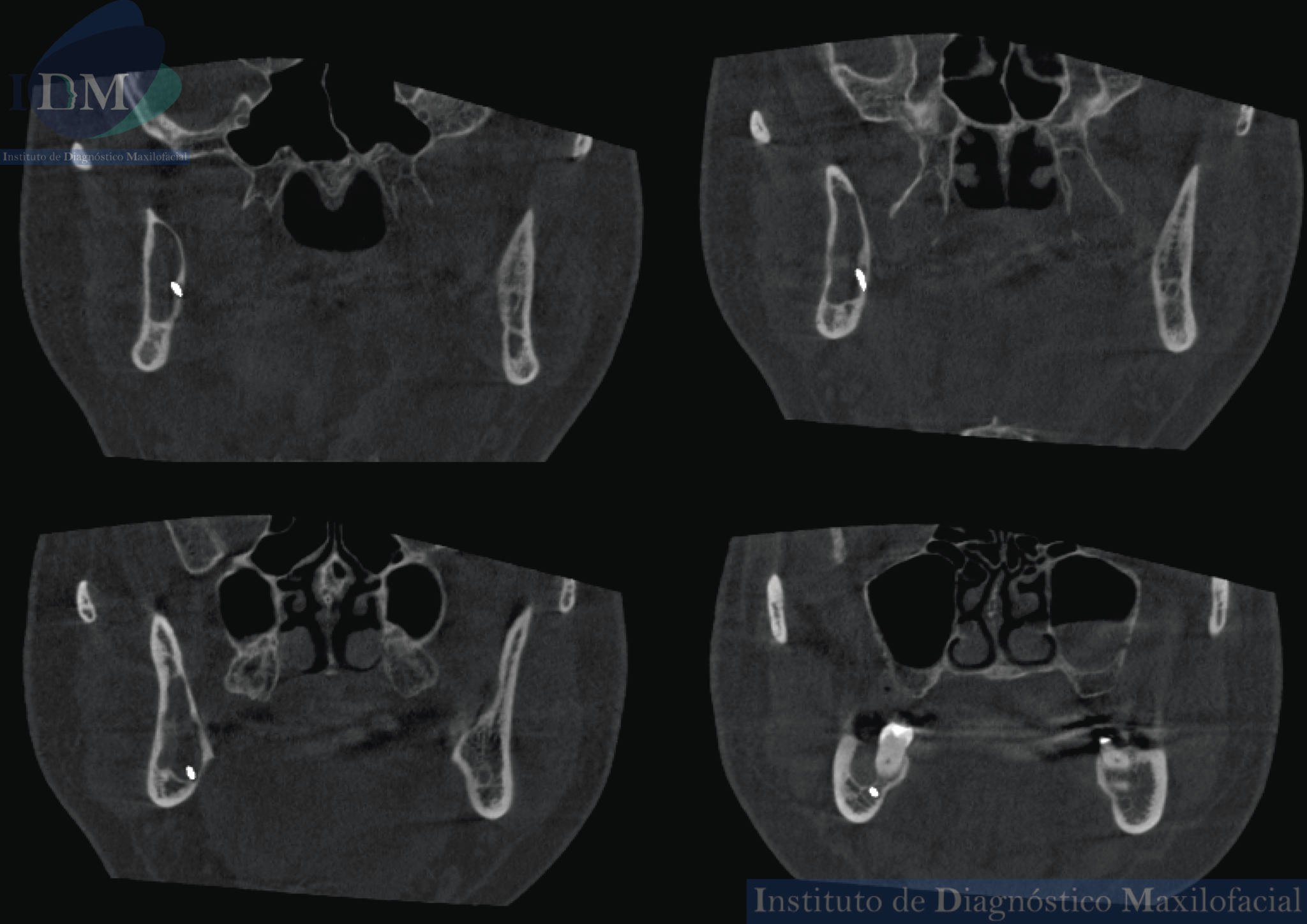 Caso 260 - IDM - QUERATOQUISTE ODONTOGÉNICO MANDIBULAR - IDM