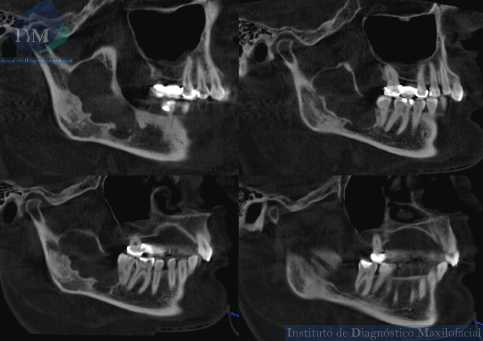 Caso 260 - IDM - QUERATOQUISTE ODONTOGÉNICO MANDIBULAR - IDM