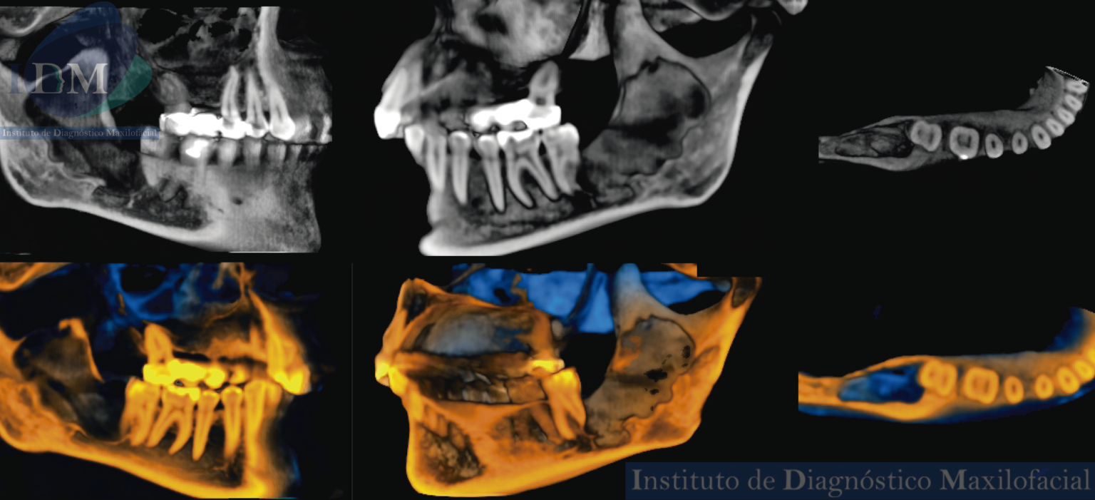 Caso 260 - IDM - QUERATOQUISTE ODONTOGÉNICO MANDIBULAR - IDM