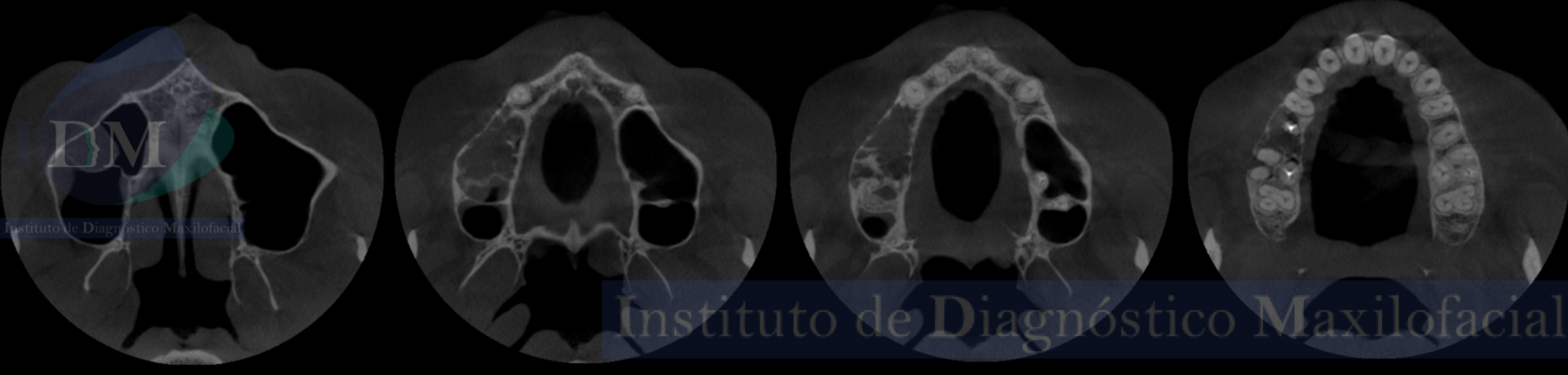 Caso 270 - IDM - MIXOMA ODONTOGÉNICO IDM - IDM