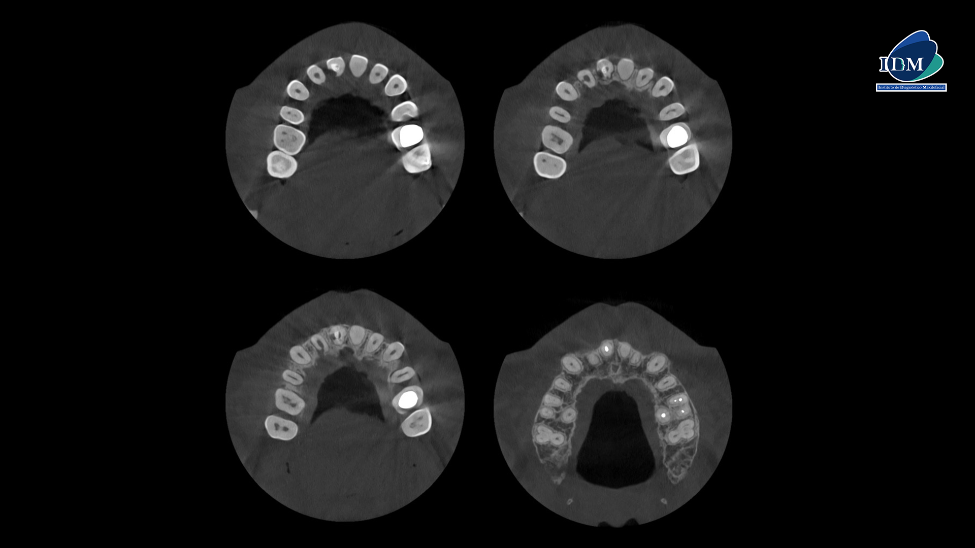 Caso 280 - IDM - REABSORCIÓN RADICULAR INTERNA – OBLITERACIÓN DE ...