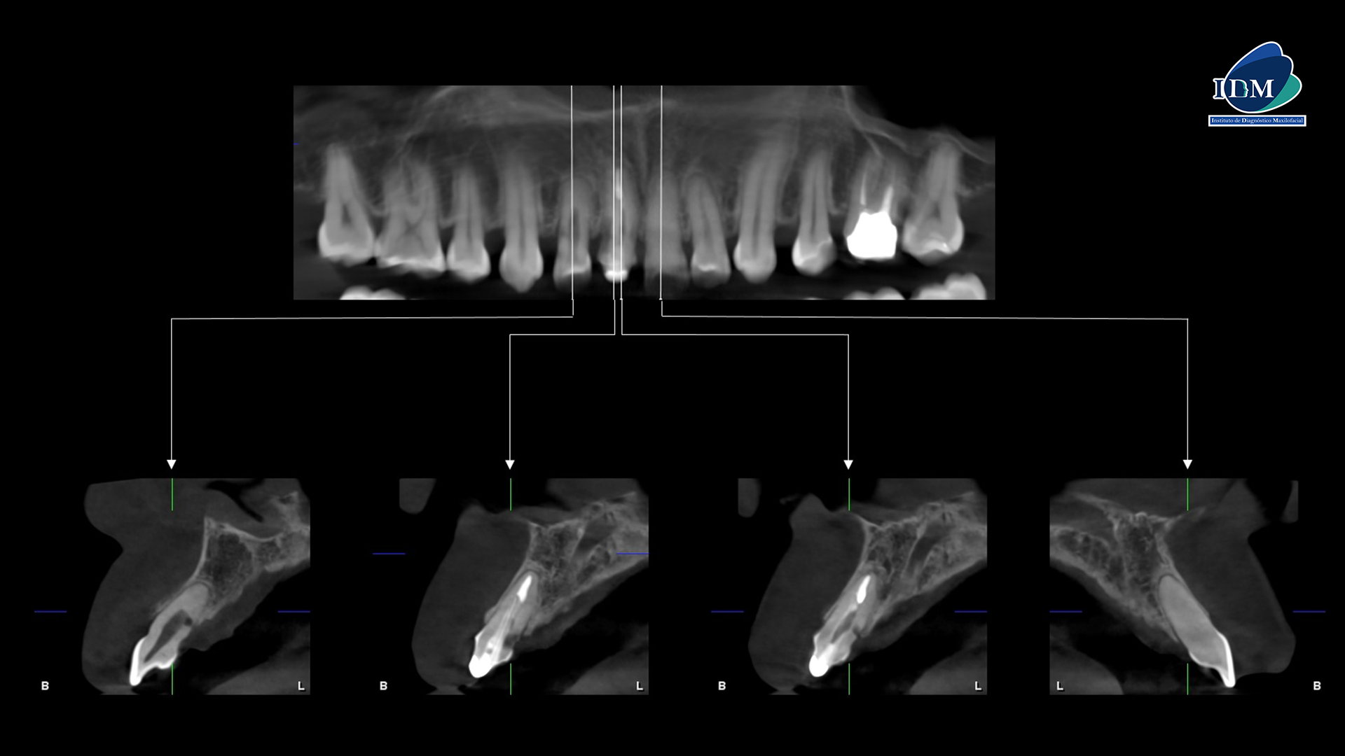 Caso 280 - IDM - REABSORCIÓN RADICULAR INTERNA – OBLITERACIÓN DE ...