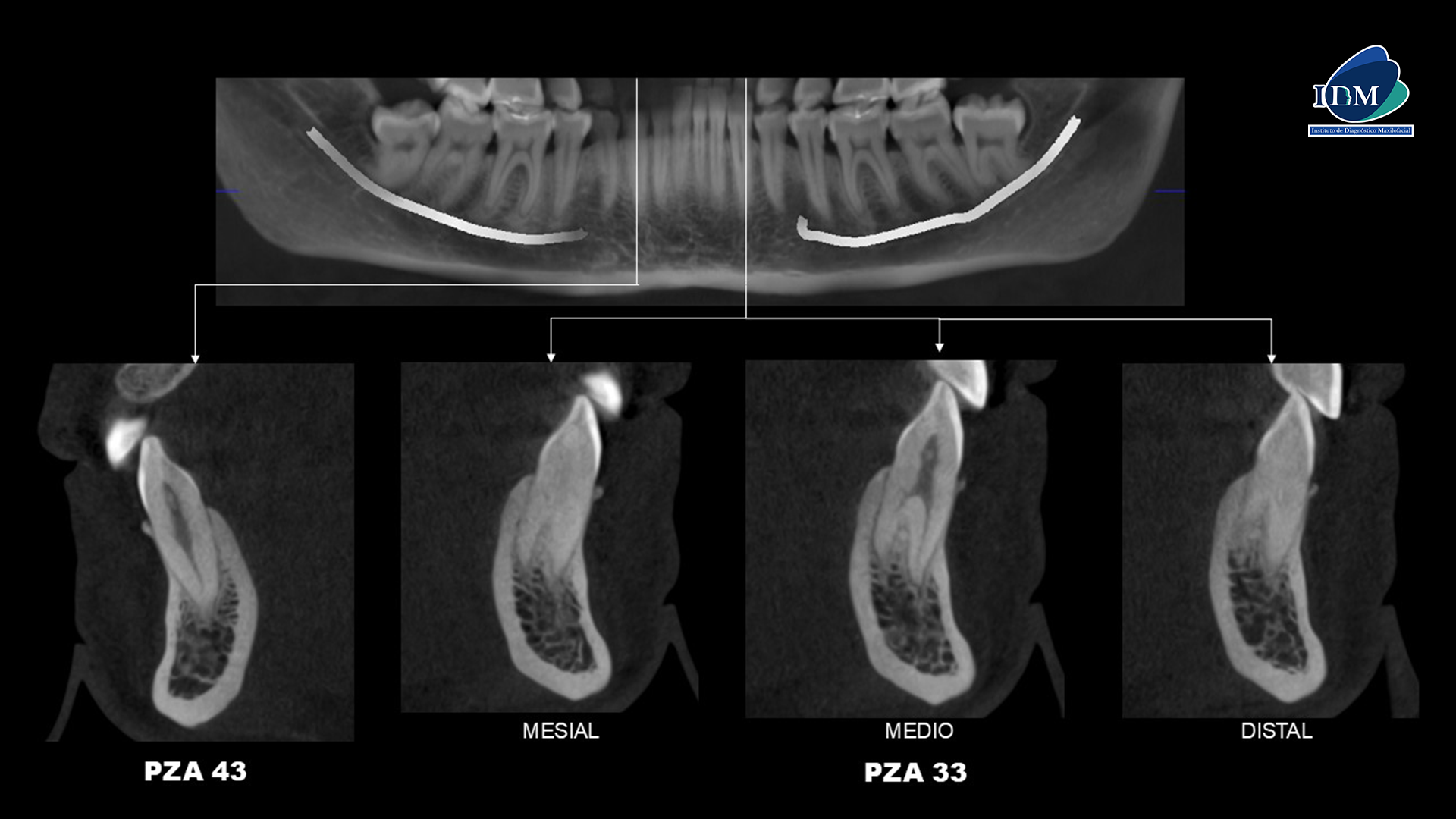 Caso 284 - IDM – BIFURCACIÓN RADICULAR EN CANINO MANDIBULAR IDM - IDM