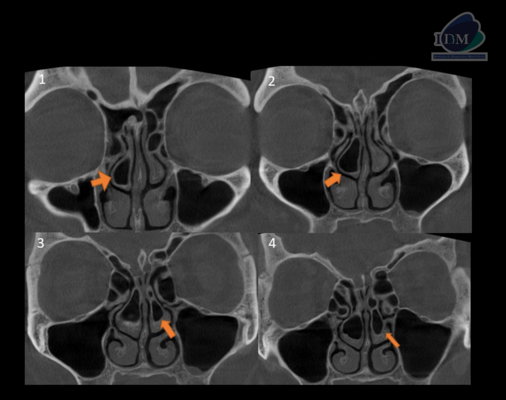 Caso 289 – IDM – CONCHA BULLOSA BILATERAL COMO HALLAZGO IMAGENOLÓGICO ...
