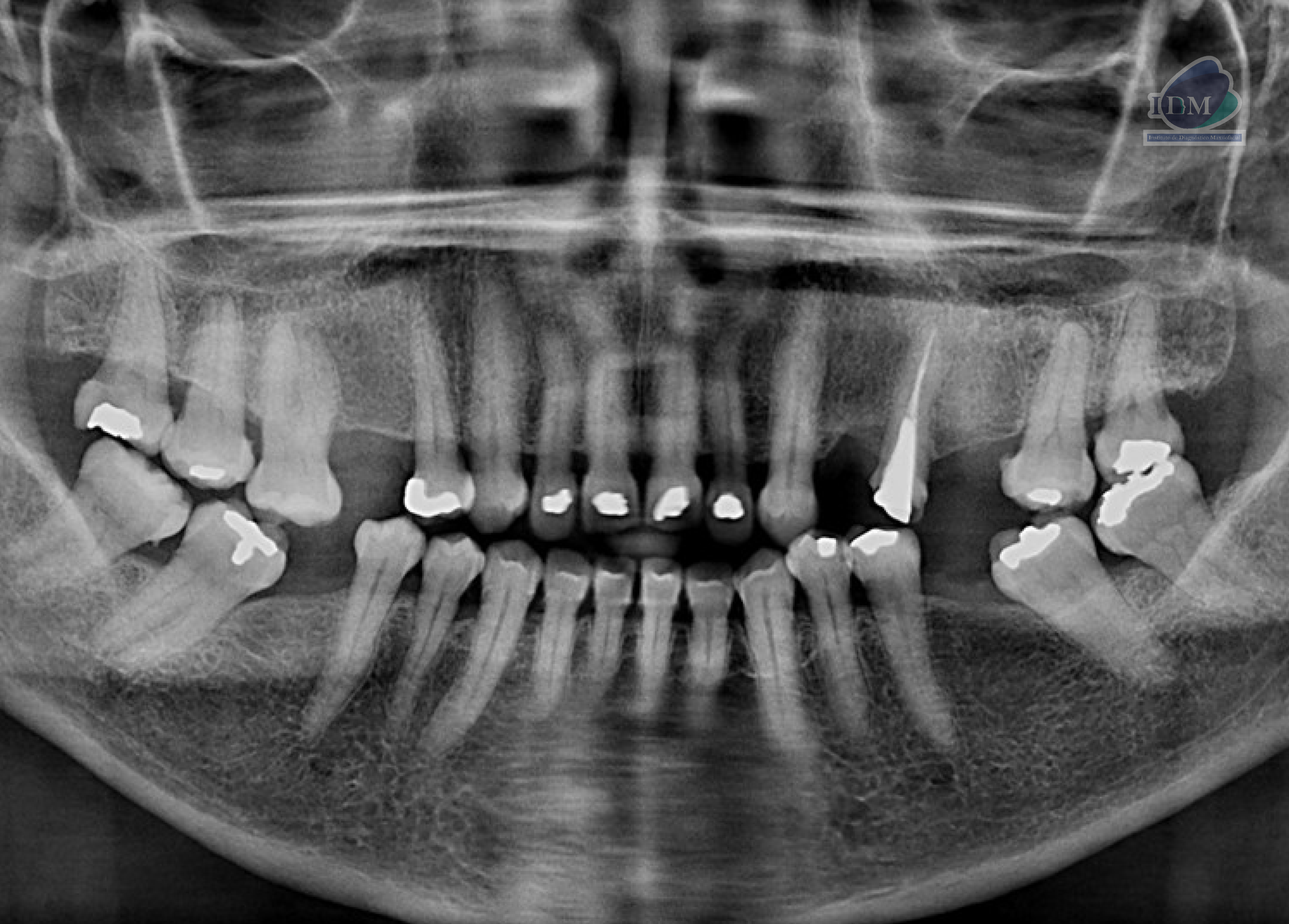 Caso 289 – IDM – CONCHA BULLOSA BILATERAL COMO HALLAZGO IMAGENOLÓGICO ...