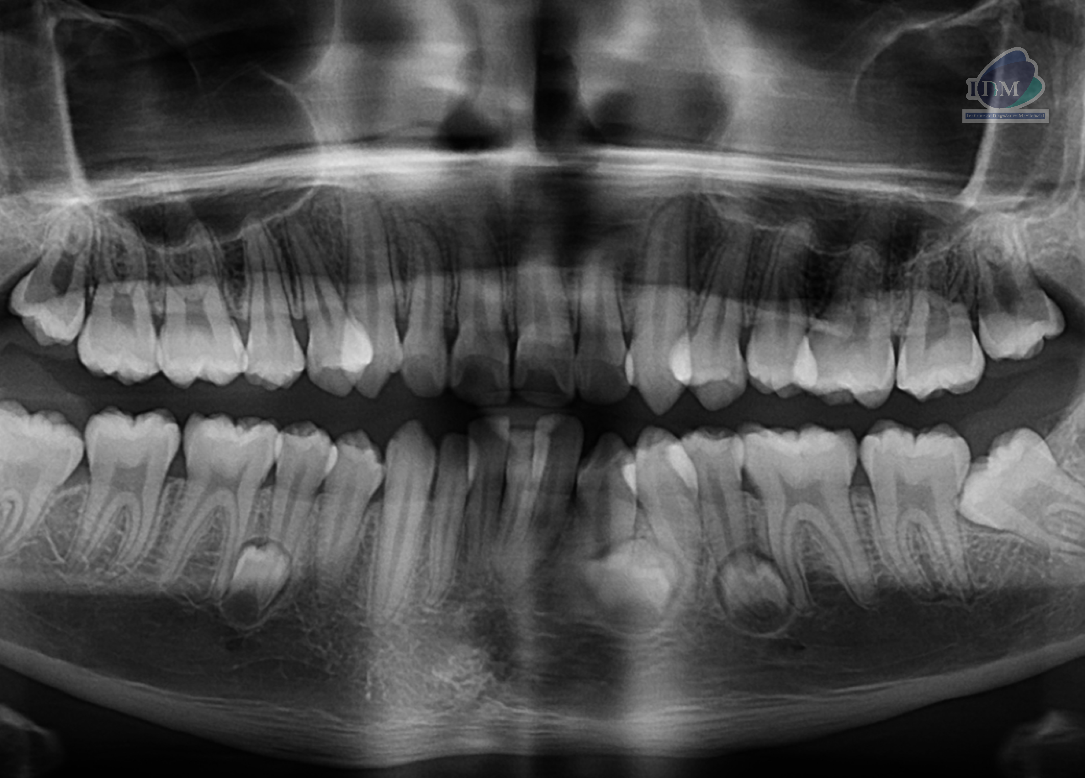 Caso 290 – IDM – DIENTES SUPERNUMERARIOS – IDM - IDM