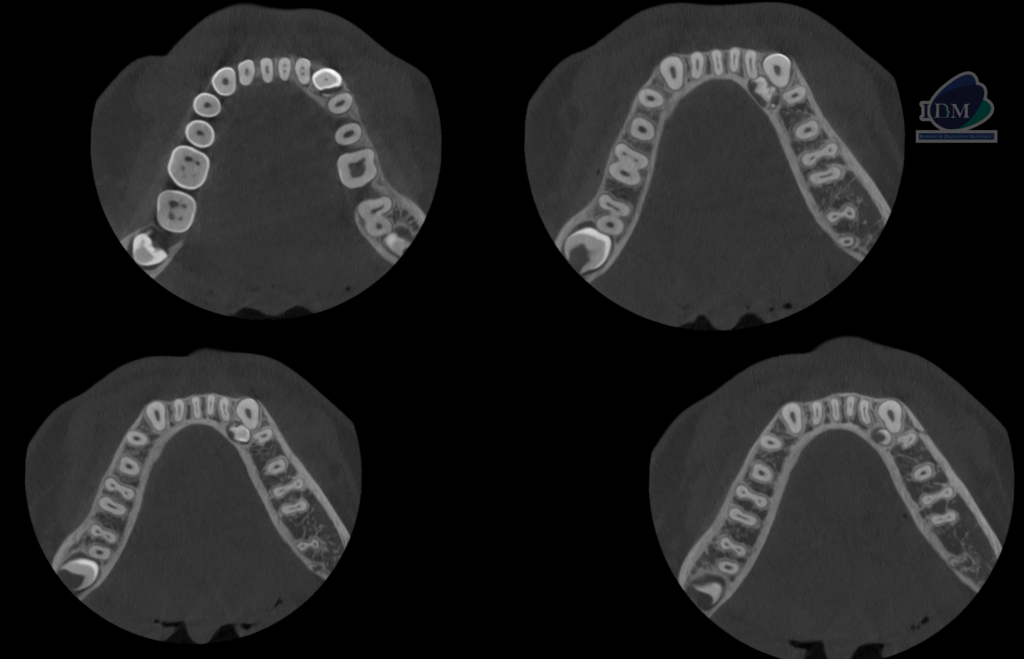 Caso 292 - IDM – ODONTOMA EN PARASINFISIS MANDIBULAR IDM - IDM
