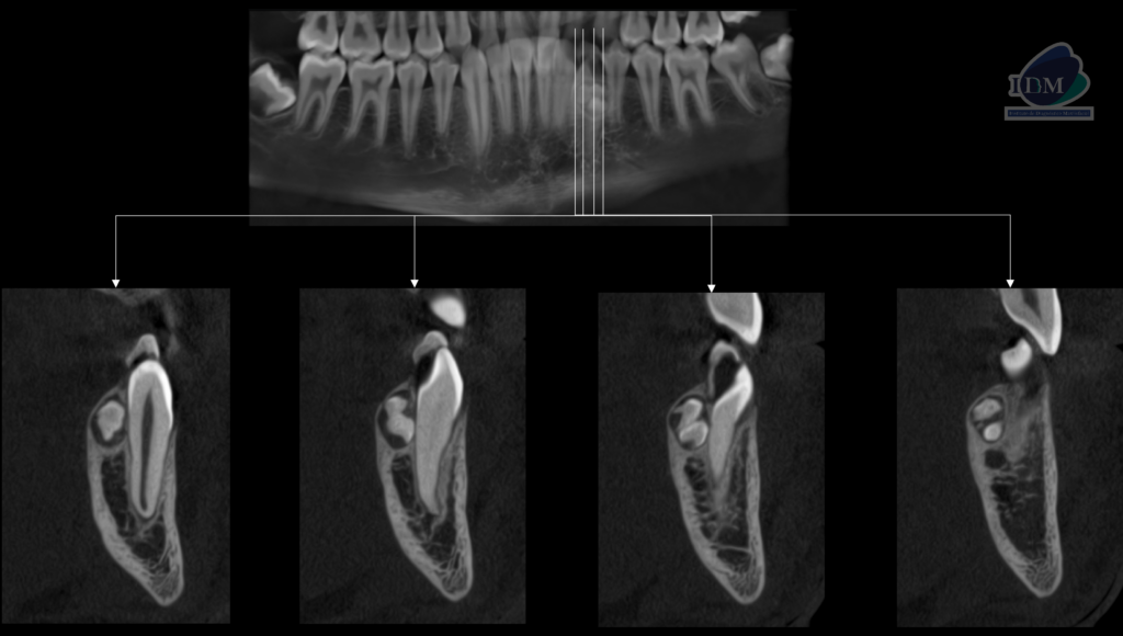 Caso 292 - IDM – ODONTOMA EN PARASINFISIS MANDIBULAR IDM - IDM