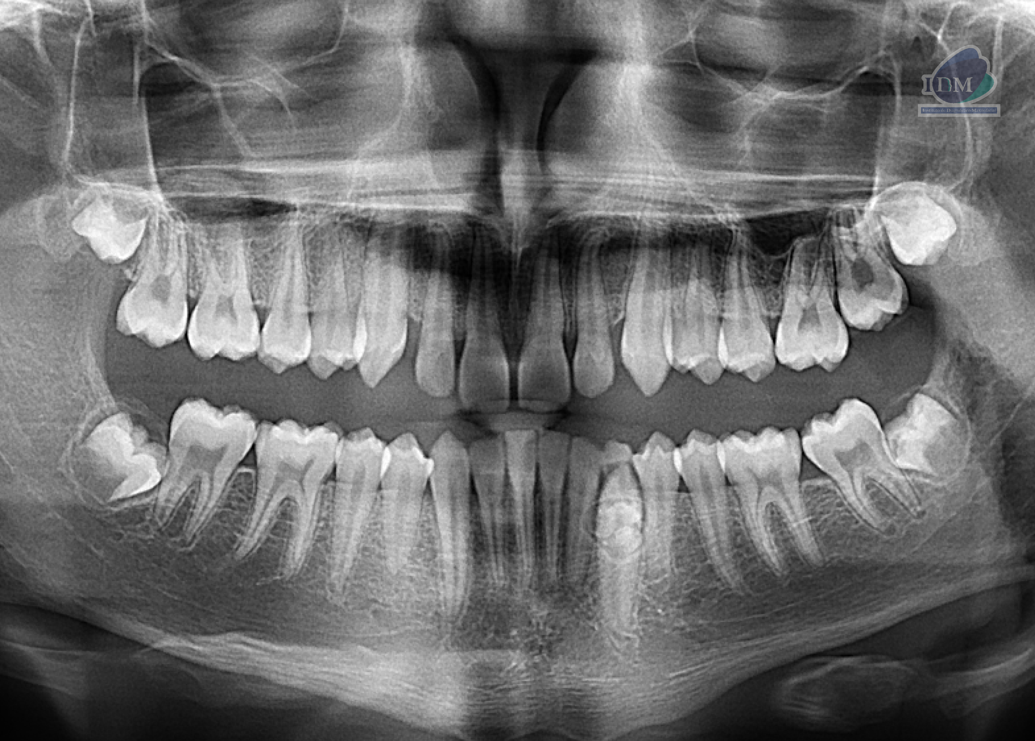 Caso 292 - IDM – ODONTOMA EN PARASINFISIS MANDIBULAR IDM - IDM