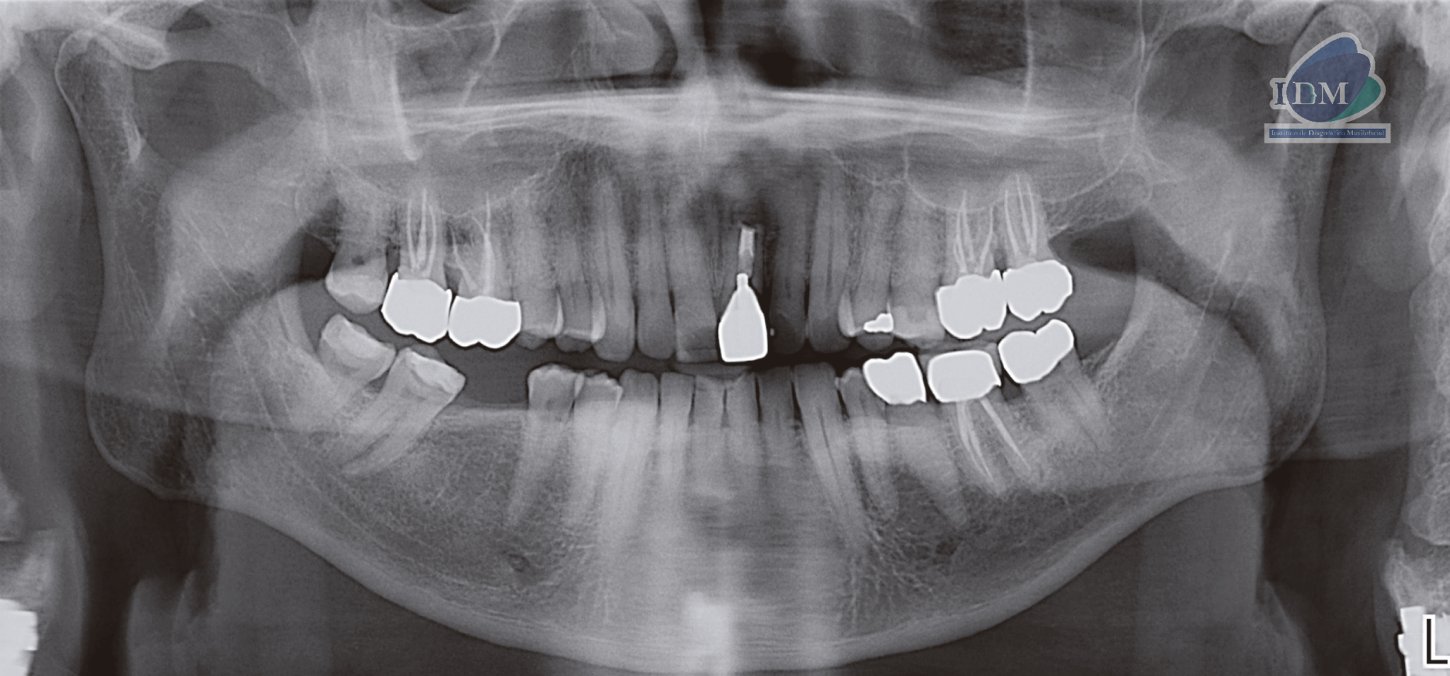 Caso 303 – IDM – TORUS MANDIBULAR - IDM - IDM