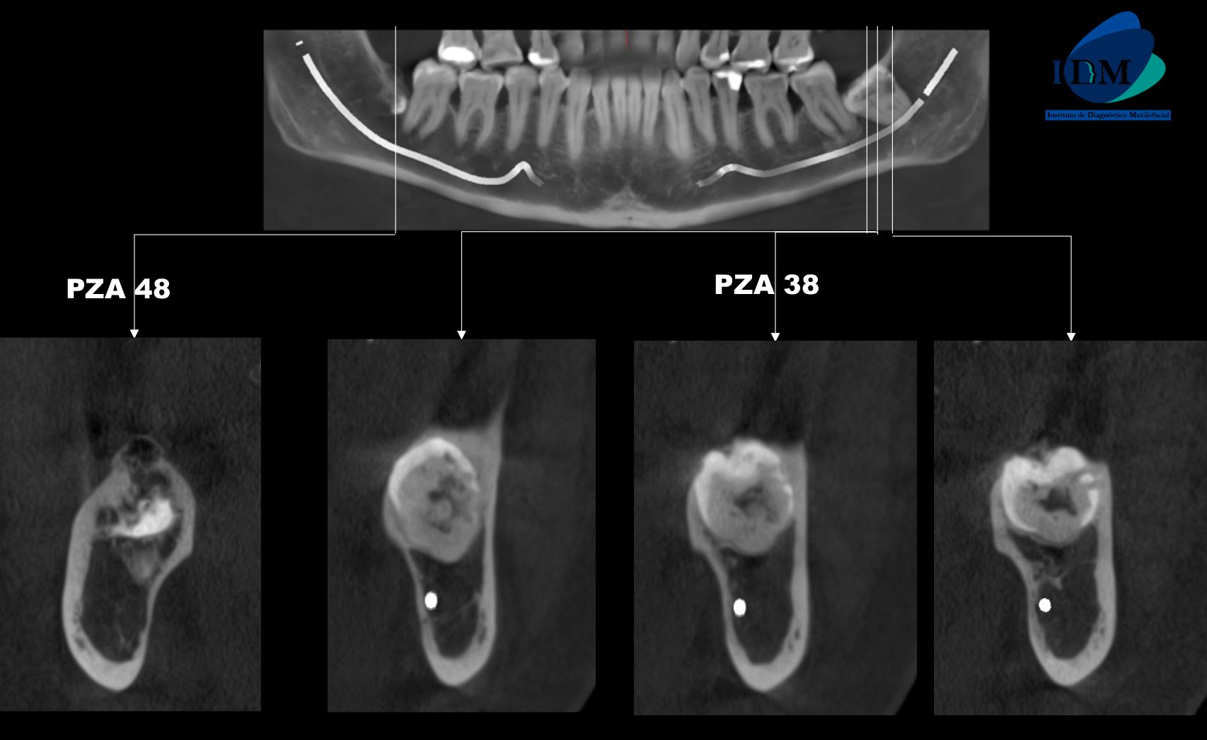 Caso 310 - IDM – AMELOCLASIA EN TERCER MOLAR MANDIBULAR IDM - IDM