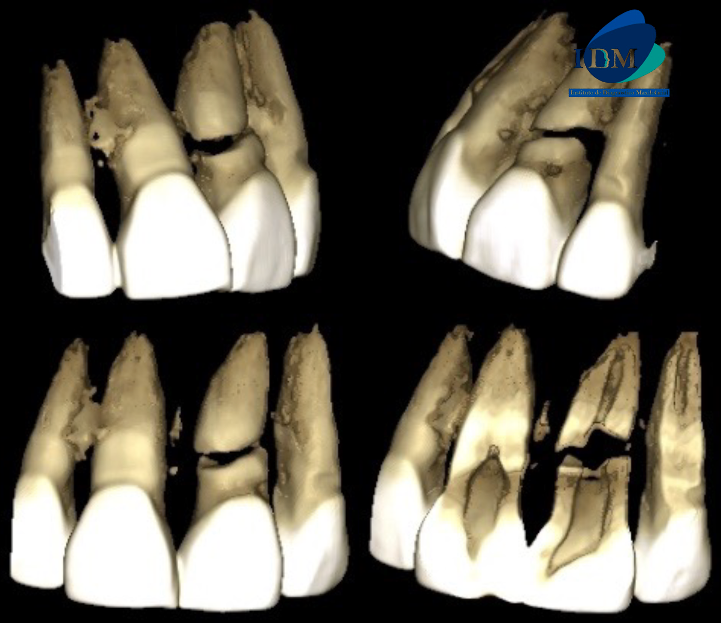 Caso 315 – IDM – FRACTURA RADICULAR - IDM - IDM