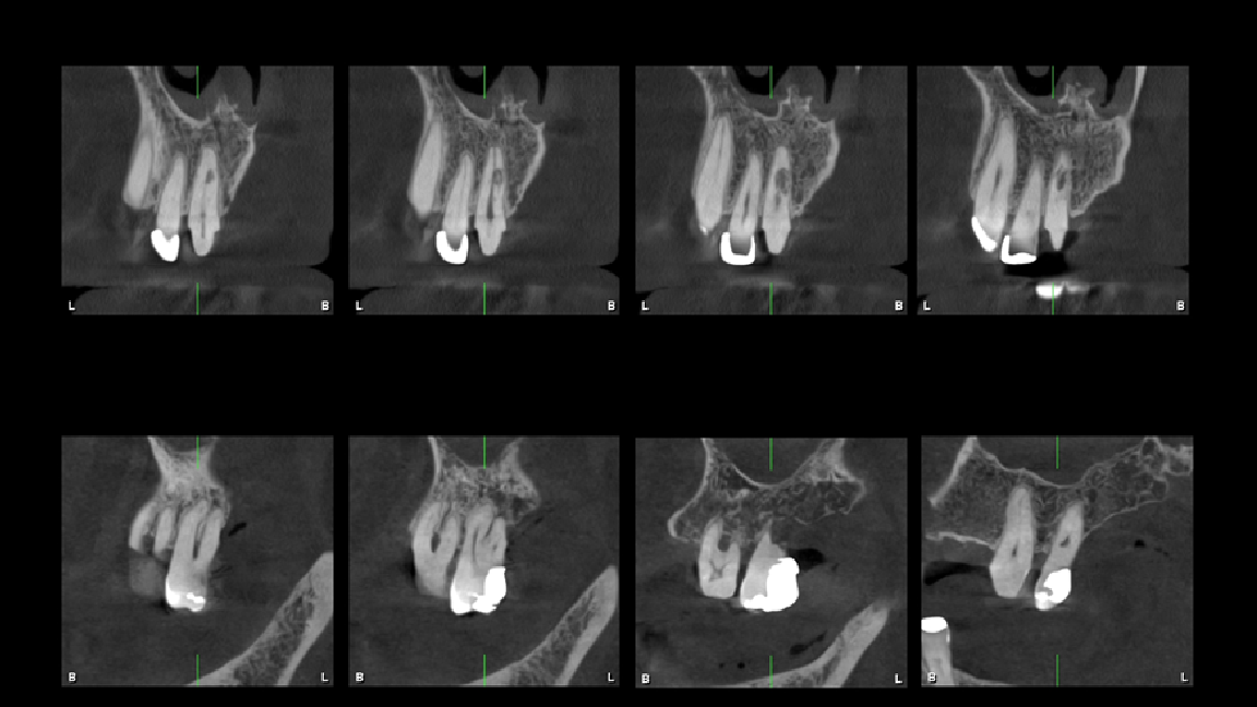 Caso 331 – IDM – REABSORCIÓN RADICULAR EXTERNA EN INCISIVO Y MOLAR ...
