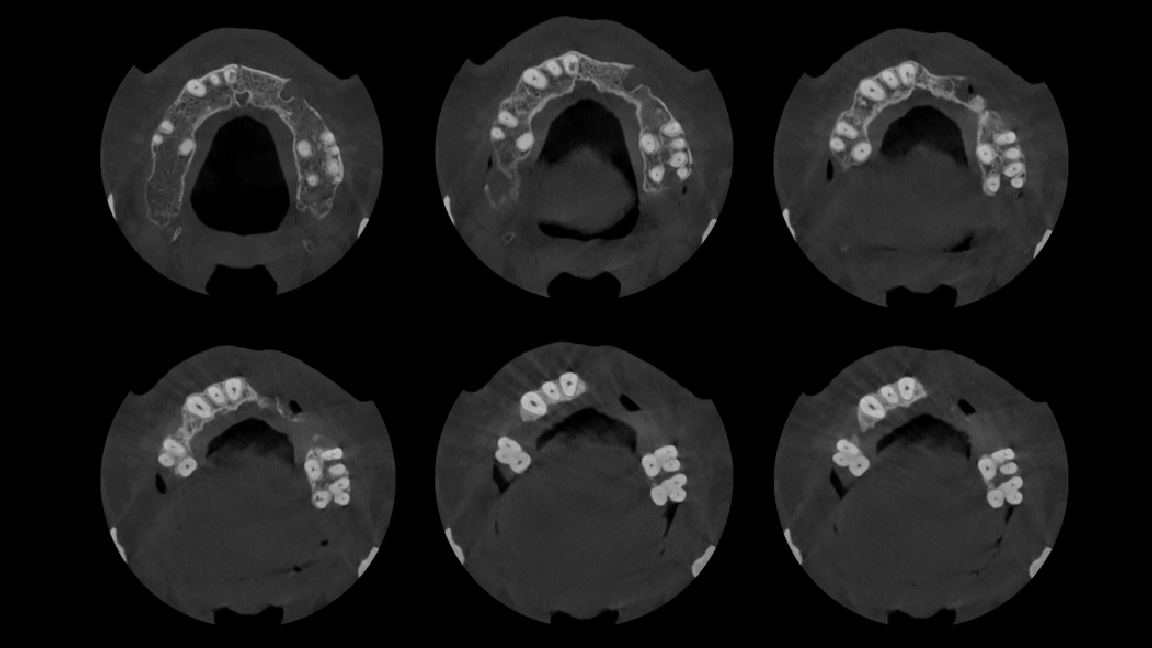 Caso 331 – IDM – REABSORCIÓN RADICULAR EXTERNA EN INCISIVO Y MOLAR ...