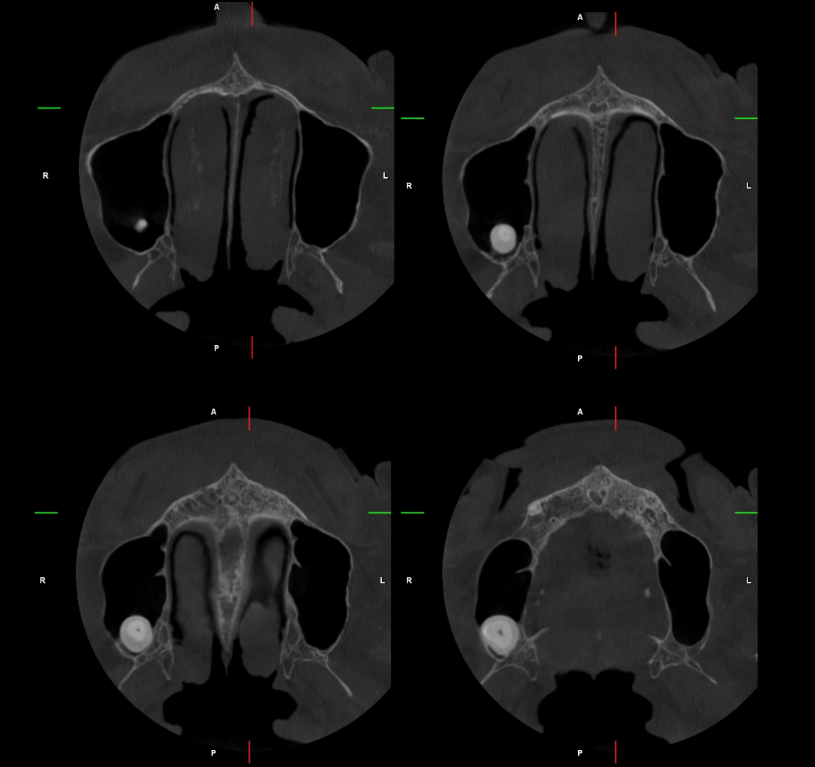 Caso 352 – IDM – ANQUILOSIS E HIPERCEMENTOSIS - IDM - IDM