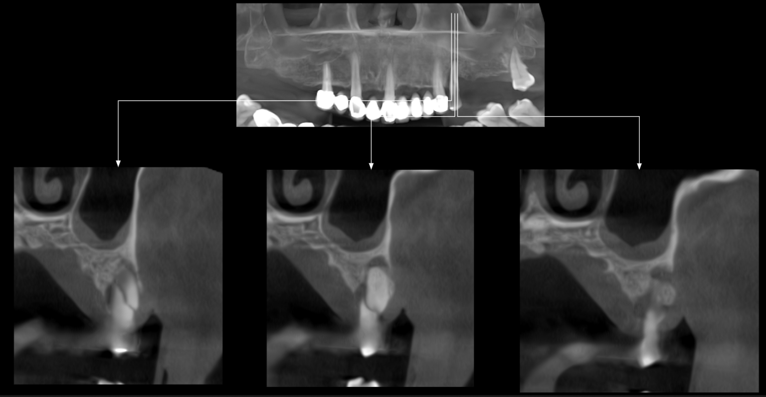 Caso 366 - EVALUACIÓN IMAGENOLÓGICA DE UNA FRACTURA RADICULAR - IDM